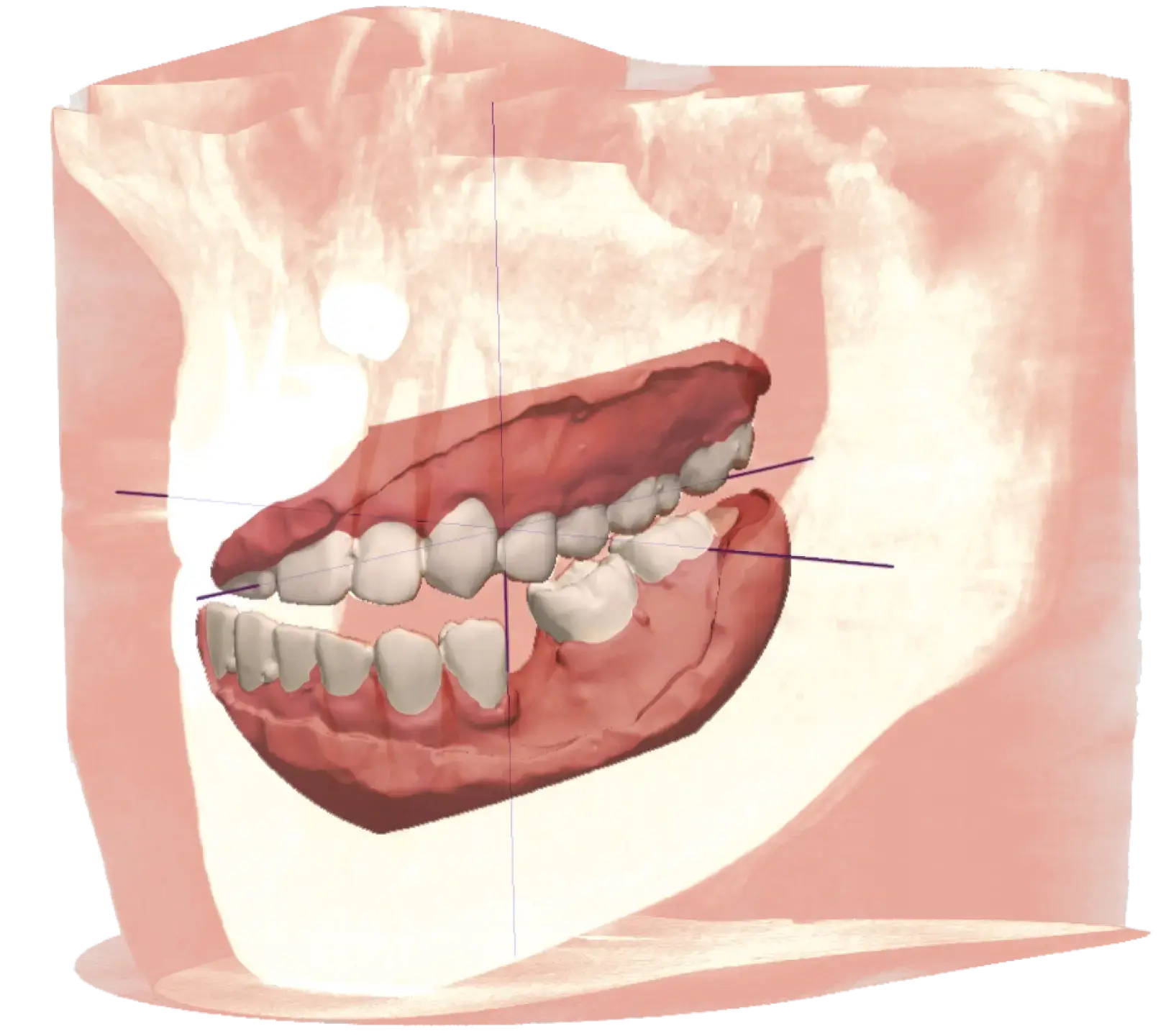 Scanned partial teeth data aligned on a transparent scanned skull CT ...
