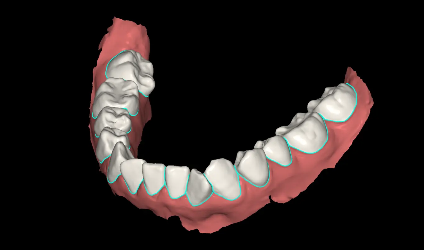 Scanned teeth data with highlighted mint blue line around each tooth