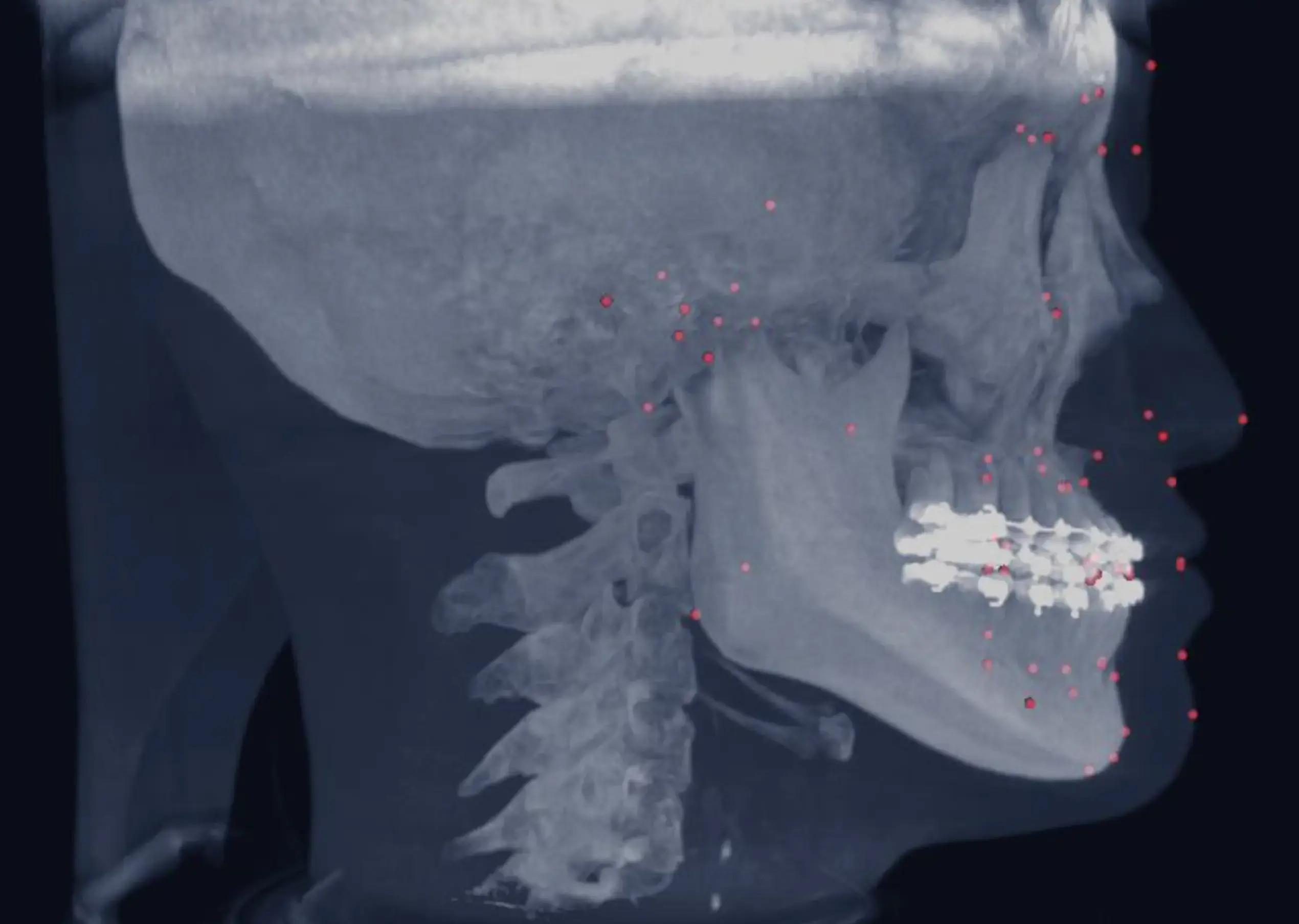 Sideview of the previous CT image