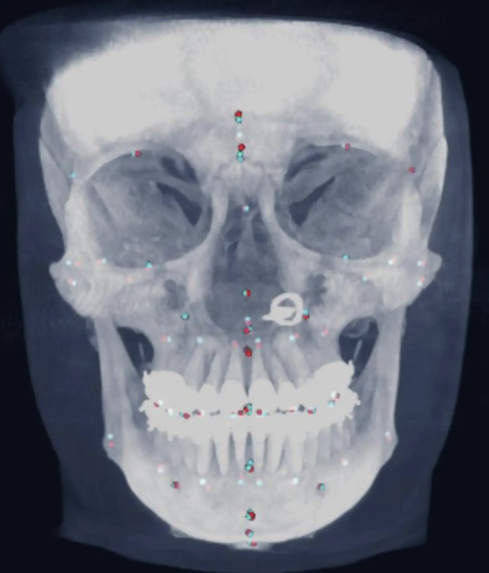 CT image of a skull with a piercing on the nose and red, blue, white ...