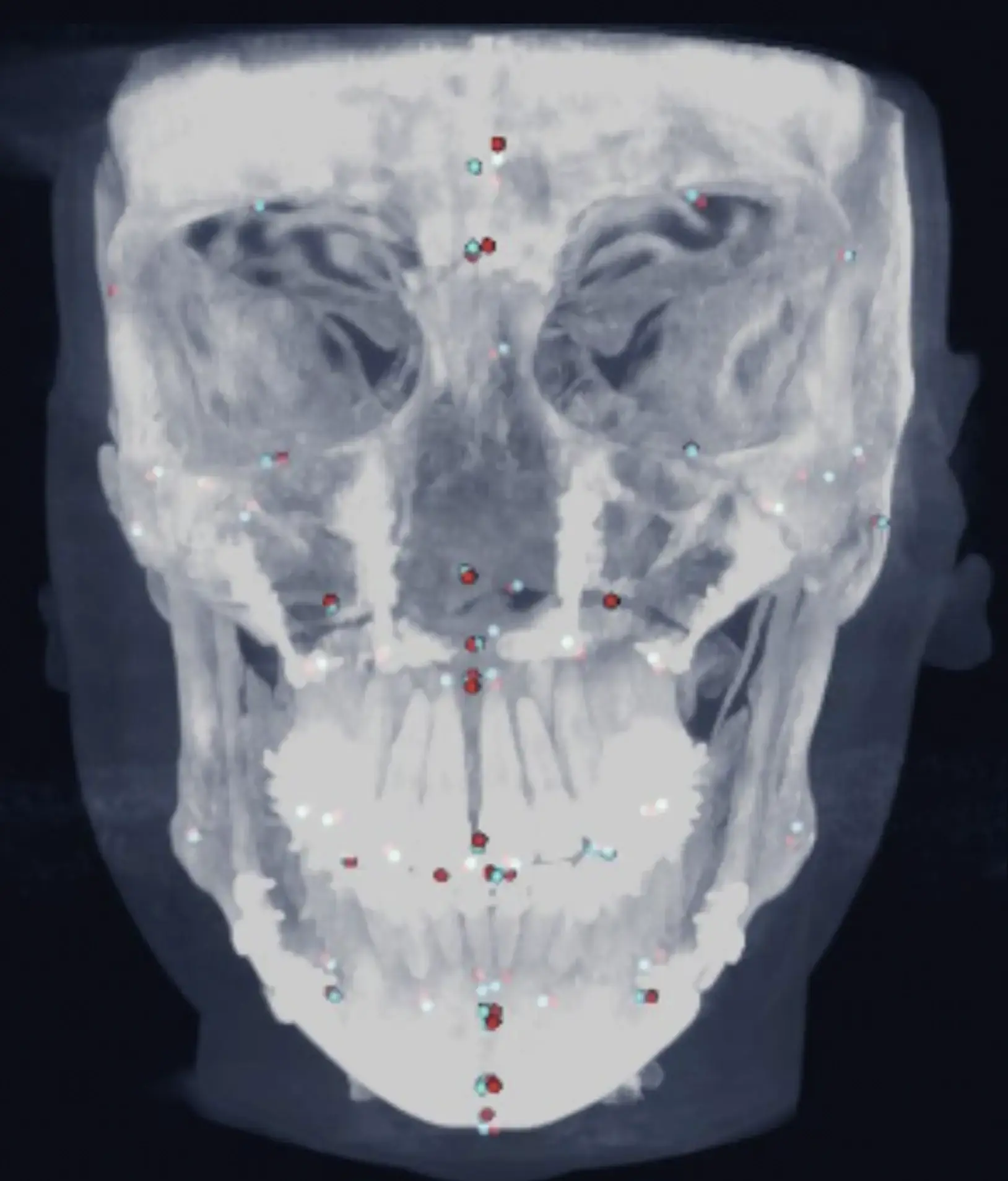 CT image of a skull with red, blue, and white dots on certain places as ...