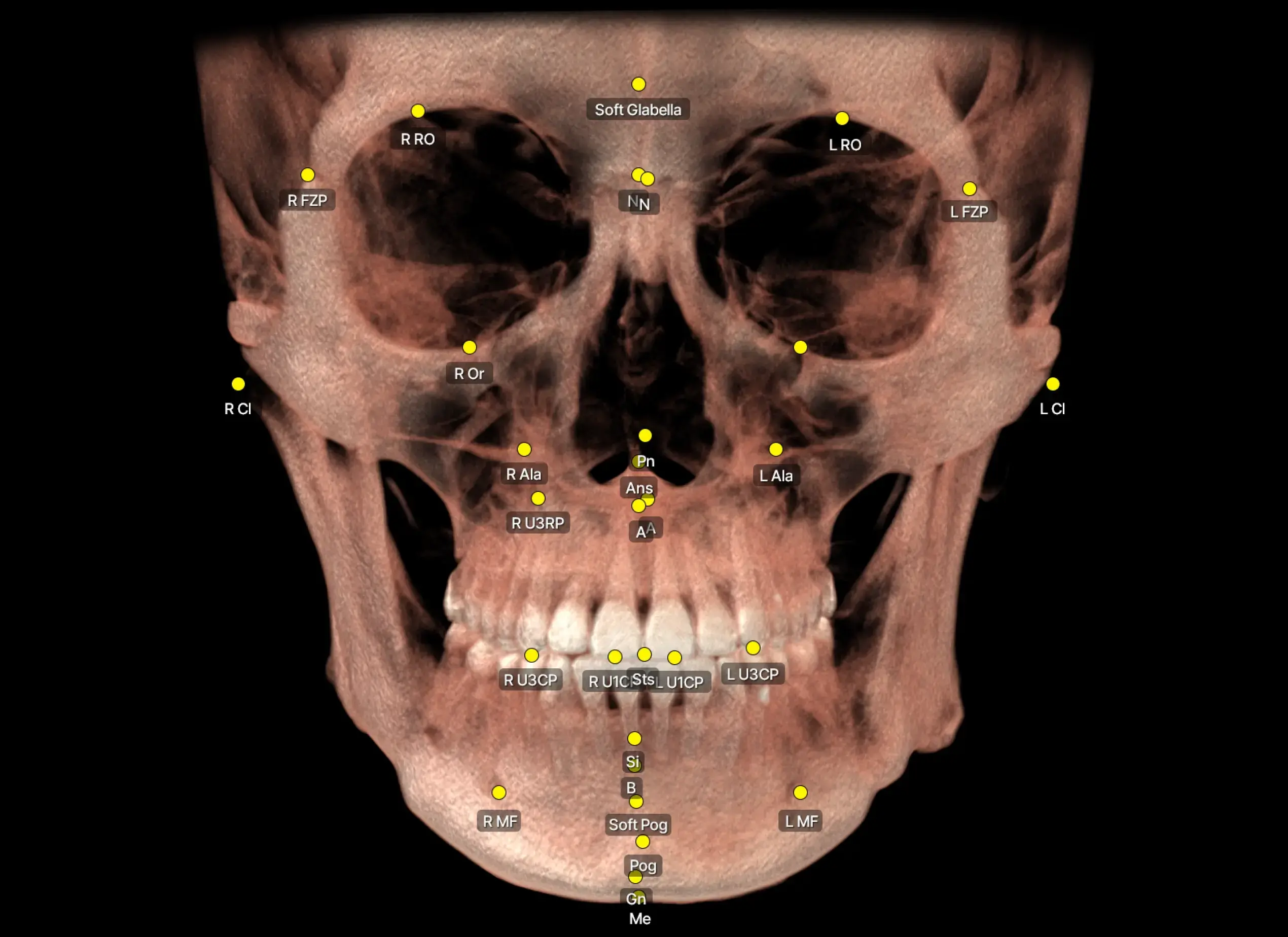 CT data of a skull with yellow dots and labels on certain places as the ...
