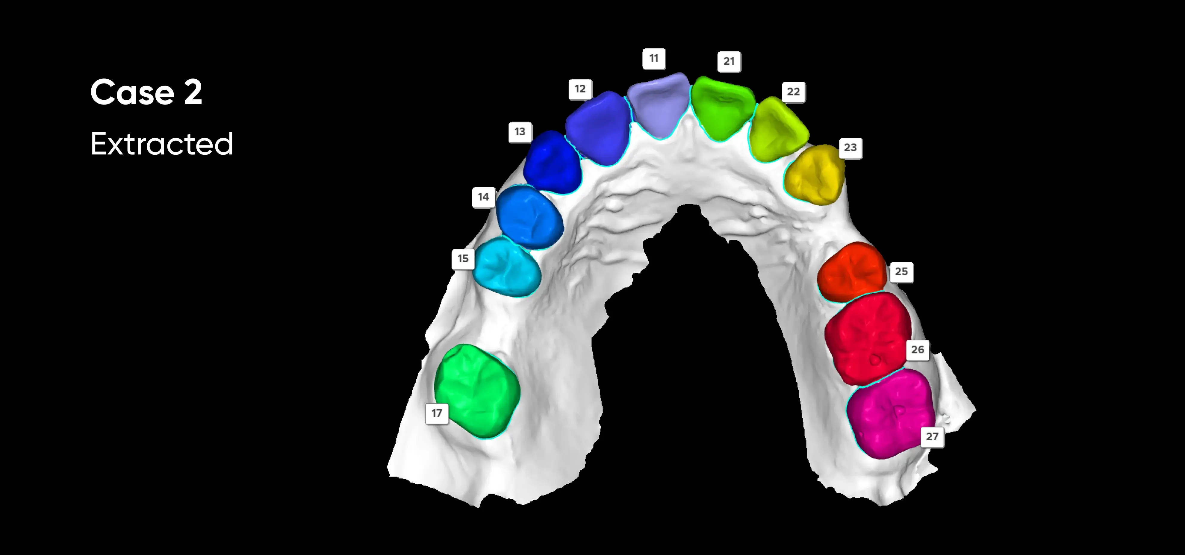 Case 2 Upper Teeth Scan With Every Tooth In Different Color And Number