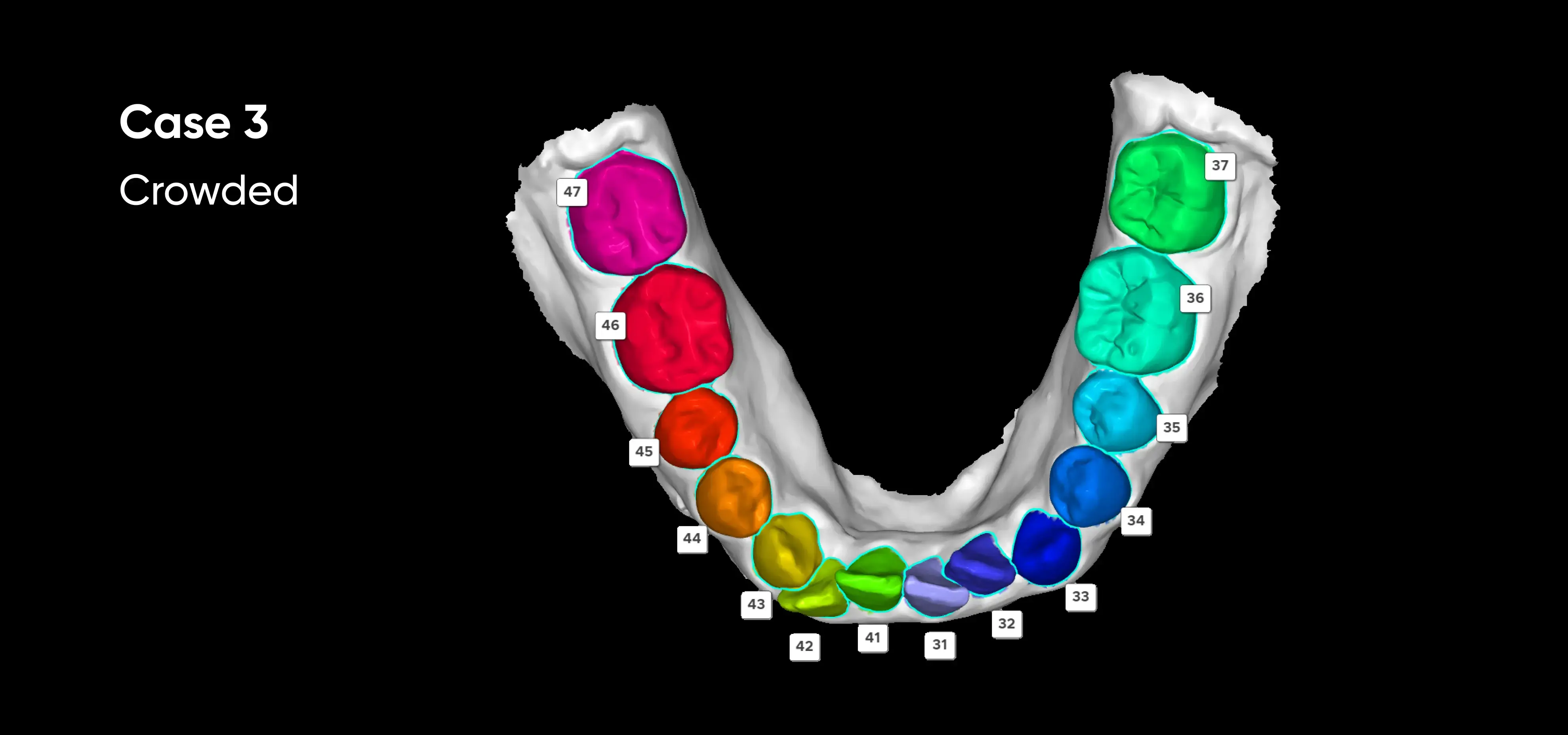 Case 3 Lower Teeth Scan With Every Tooth In Different Color And Number