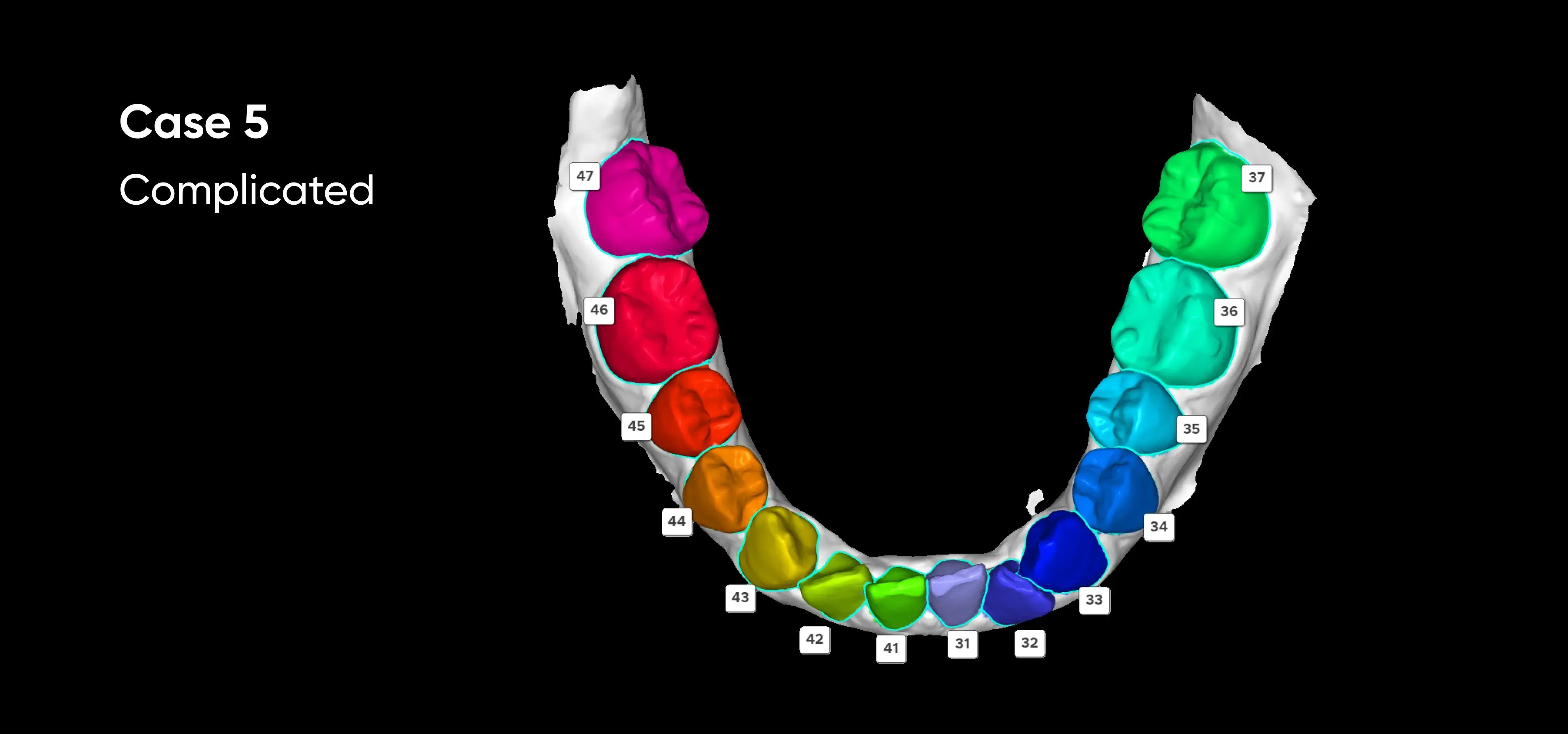 Case 5 Lower Teeth Scan With Every Tooth In Different Color And Number